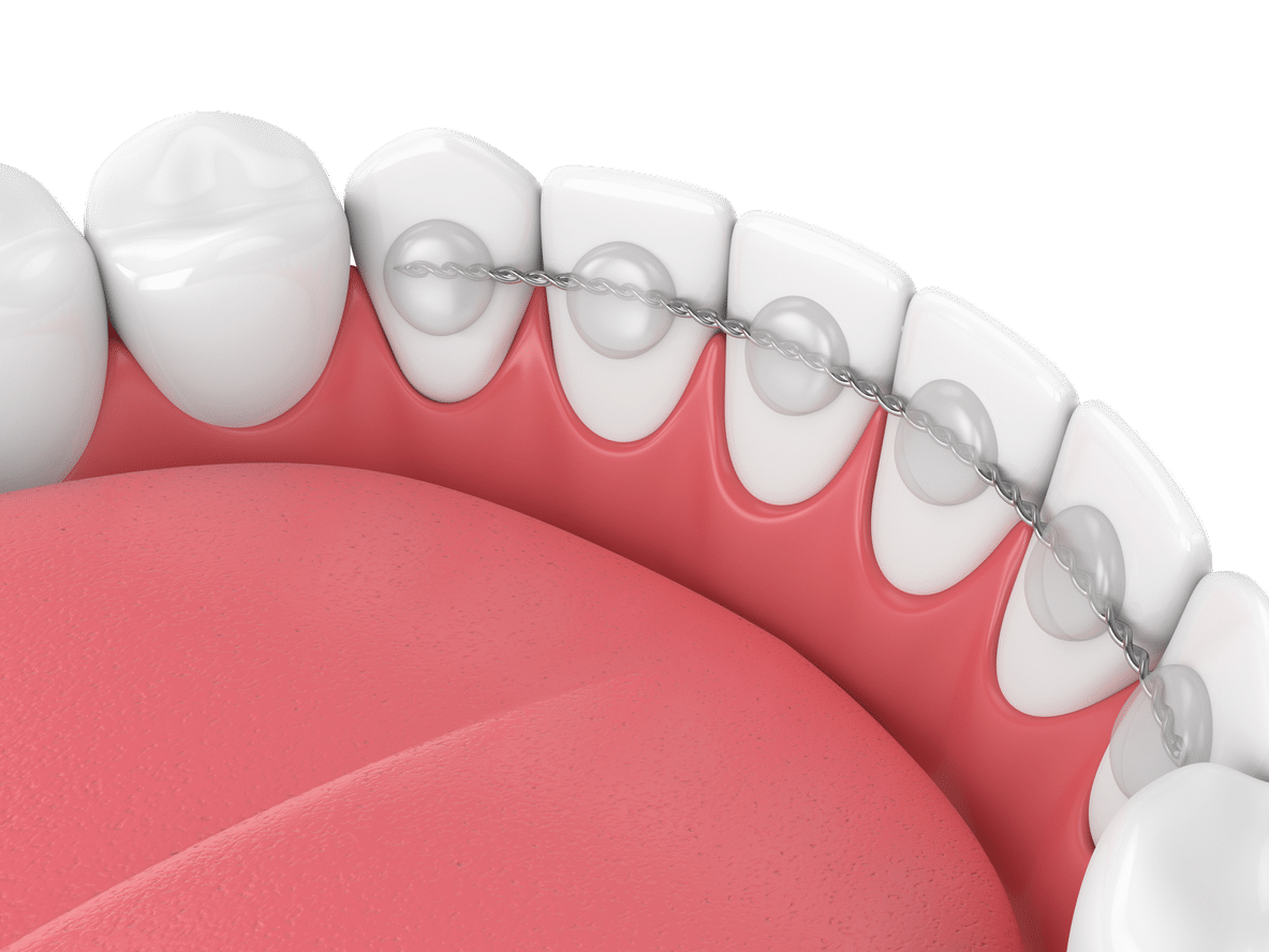 Top Orthodontists in Springfield, Beavercreek, and Beyond | Dhingra ...